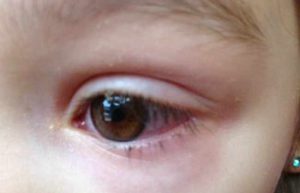 Que es la conjuntivitis neonatal | MundoMujeres.es
